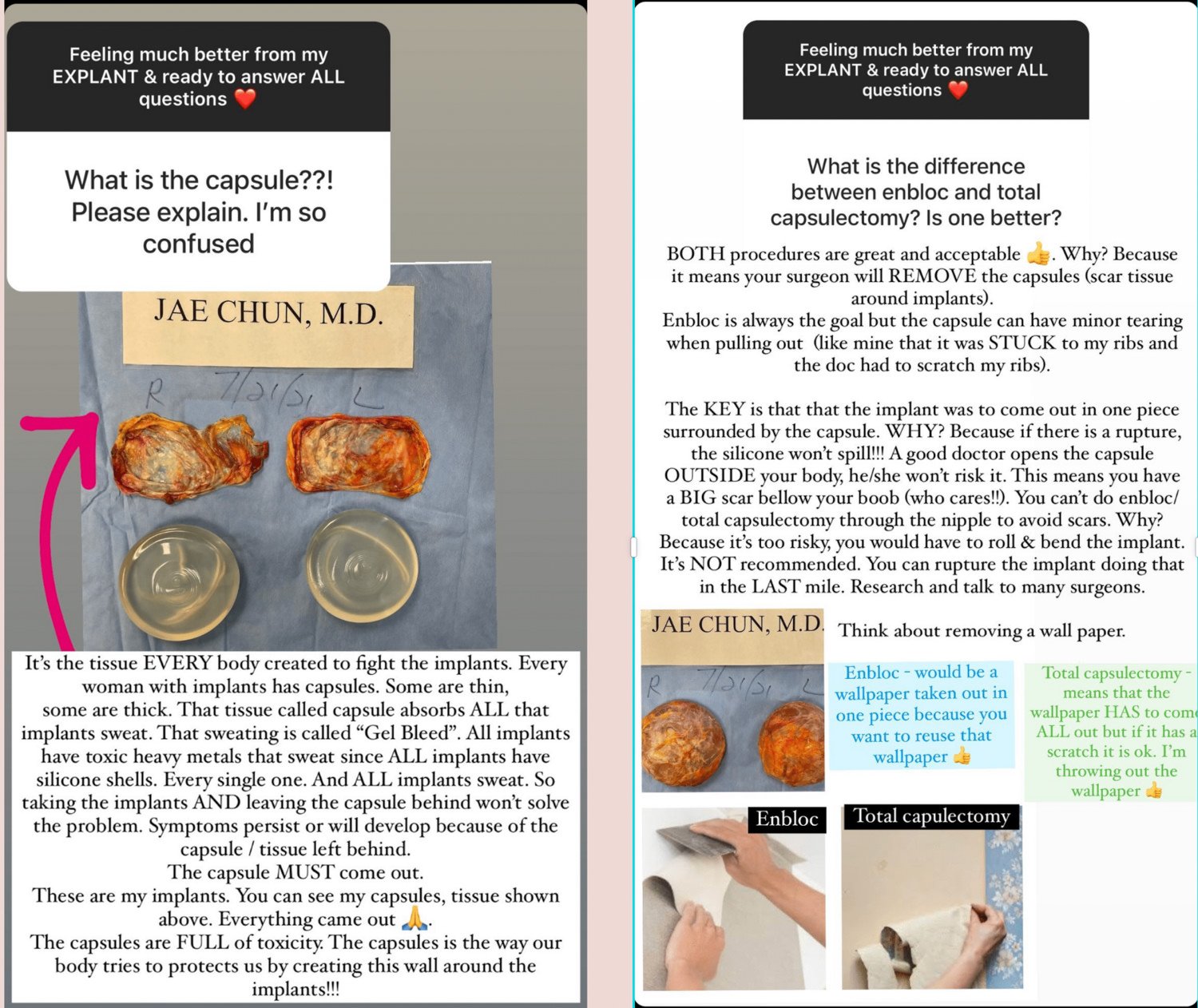 My Explant Journey Becoming A Breast Implant Illness Advocate