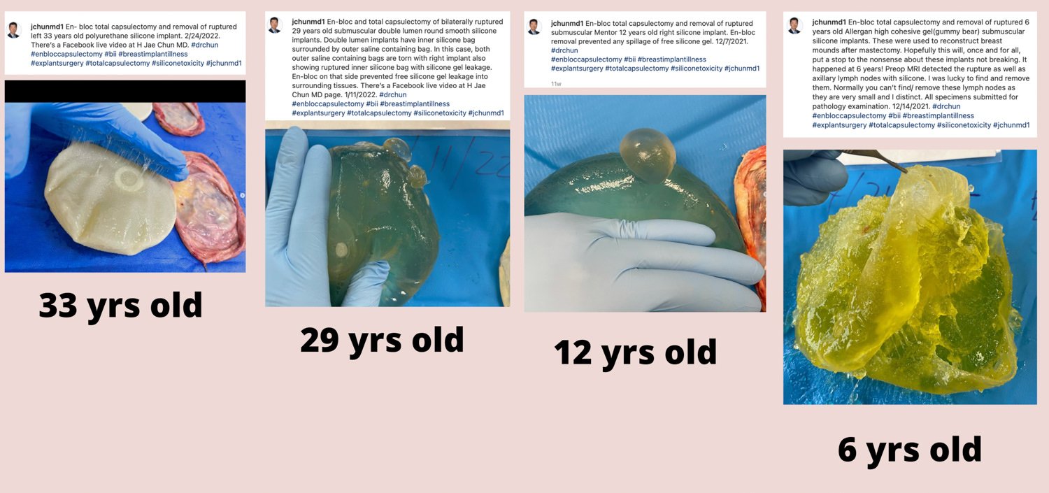 My Explant Journey Becoming A Breast Implant Illness Advocate
